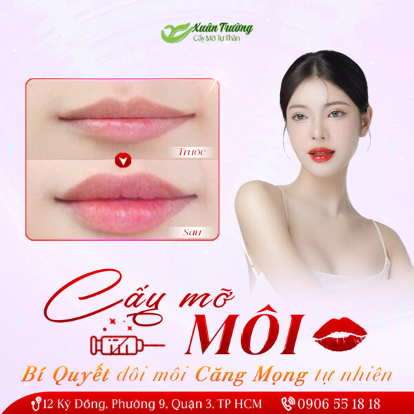 Cấy mỡ môi – Giải pháp cho đôi môi căng mọng và tự nhiên